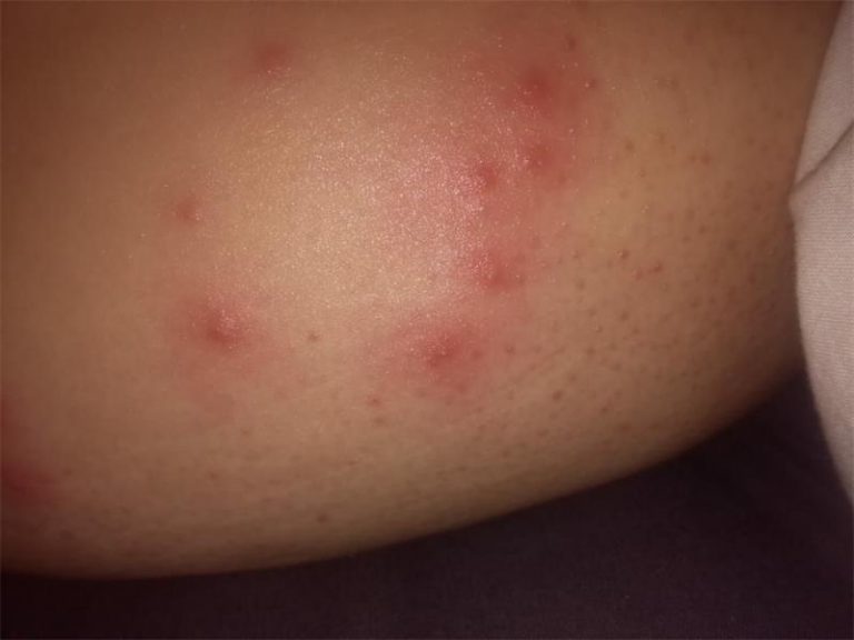 Man warns of mango fly infestation in humans | The Citizen