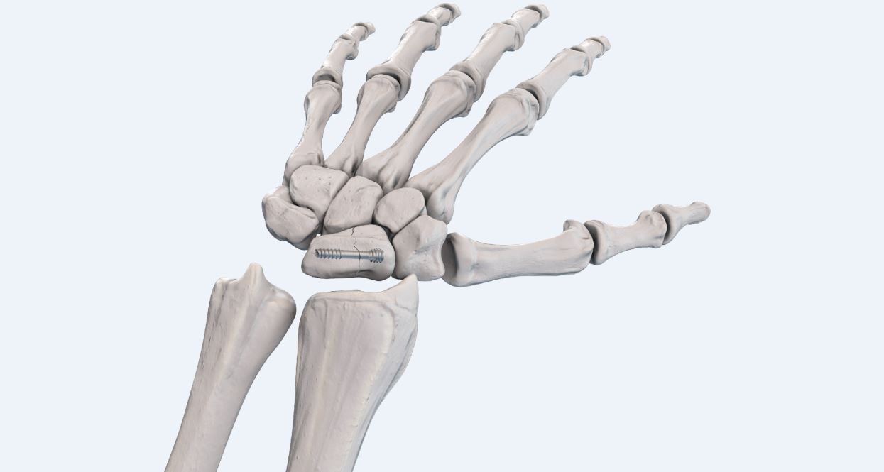 Mending broken bones just got a lot easier | The Citizen