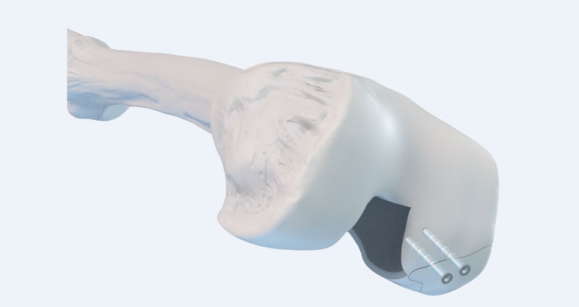 Mending broken bones just got a lot easier | The Citizen