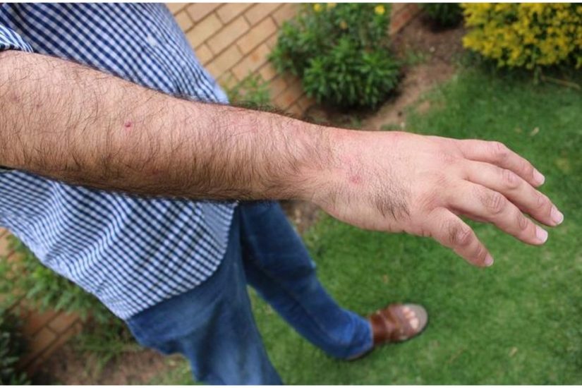 Centurion man stung over 500 times by bees