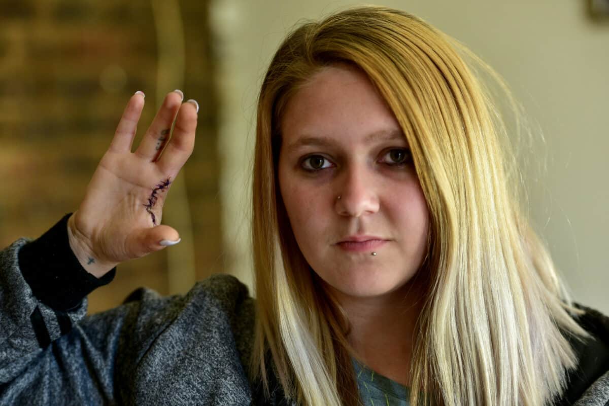 'I watched my finger rot,' says woman following freak accident