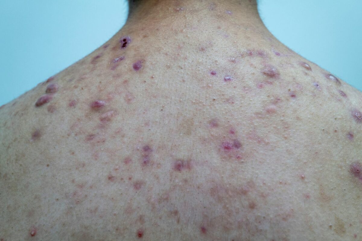 Beat the ‘ugly’: Tips to deal with common summer skin conditions