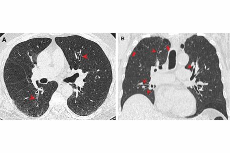 Smoking marijuana may be more harmful to smoker's lungs than tobacco ...