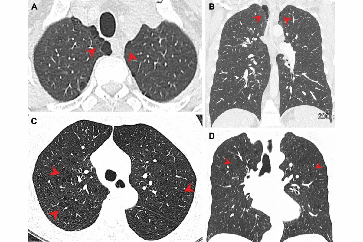 Smoking marijuana may be more harmful to smoker's lungs than tobacco ...