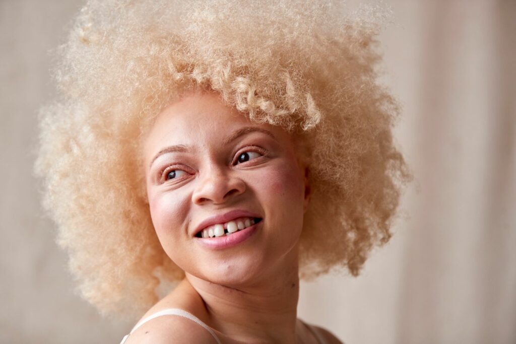 Everything you need to know about albinism | The Citizen