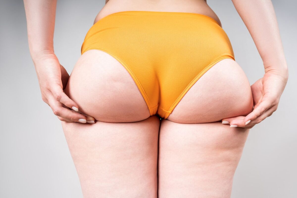 Here's everything you need to know about the Brazilian butt lift