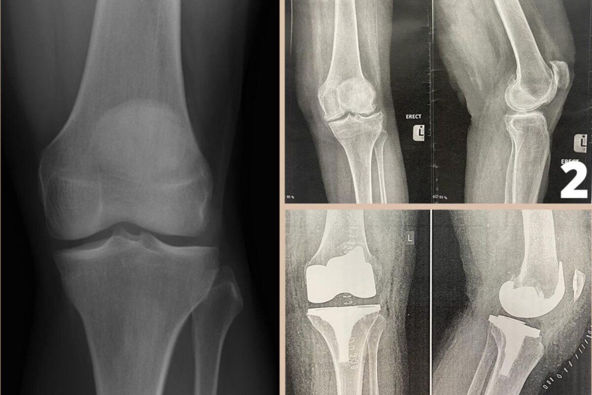 Precision and Longevity: Robotic-aided knee ops rock | The Citizen