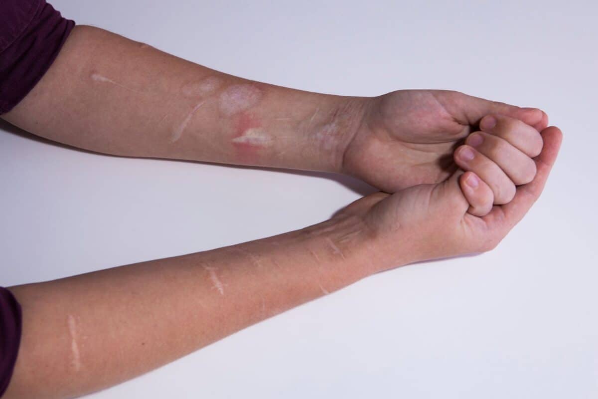 4 reasons why people cut themselves