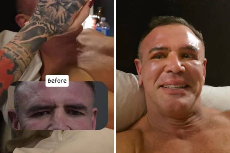 ‘Boo Bear’ Calven Robinson undergoes cosmetic eyebrow surgery